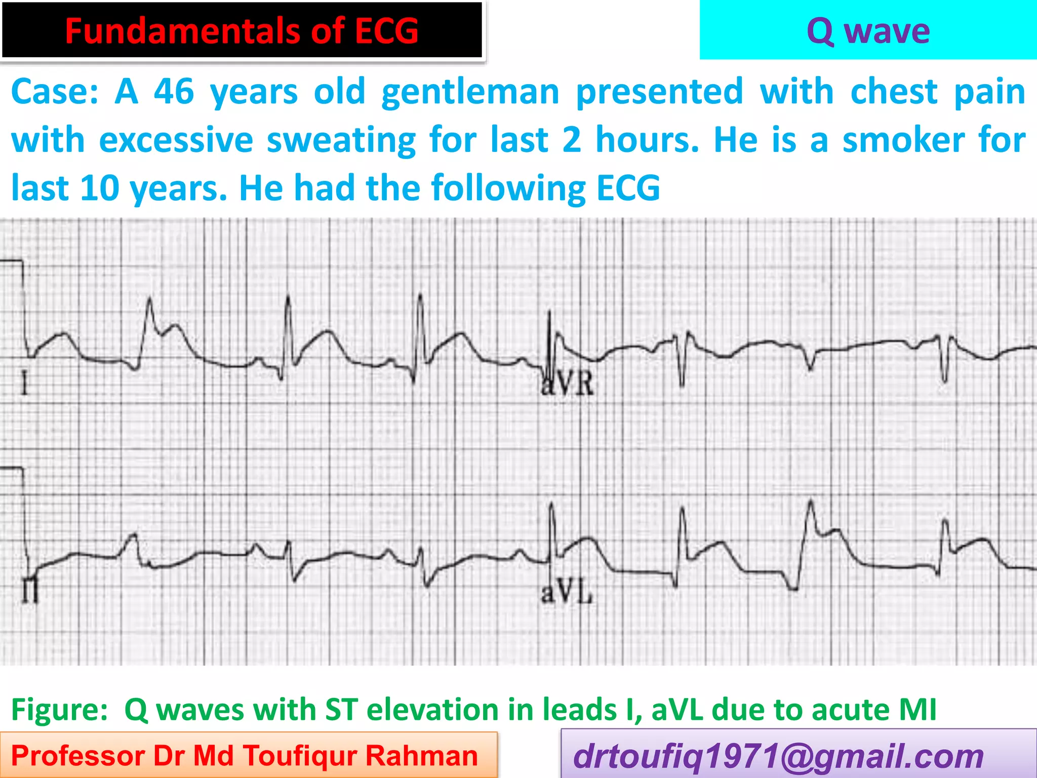 Approach to a patient with Q wave abnormality in ECG | PPSX