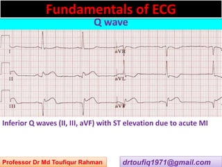 Approach to a patient with Q wave abnormality in ECG | PPSX