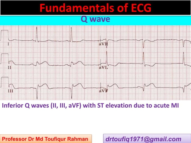 Approach to a patient with Q wave abnormality in ECG | PPT