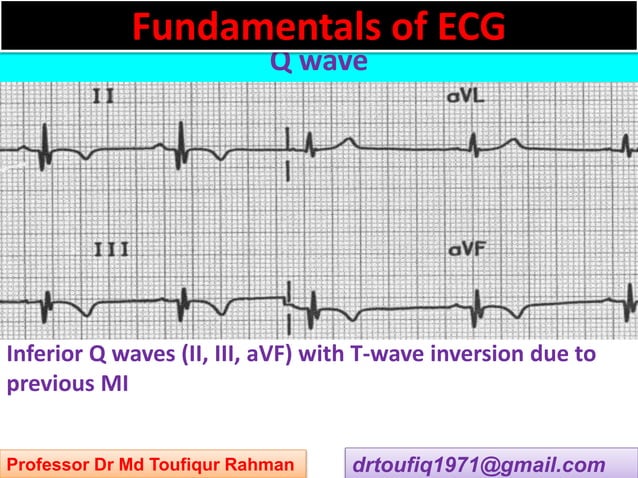 Approach to a patient with Q wave abnormality in ECG | PPT