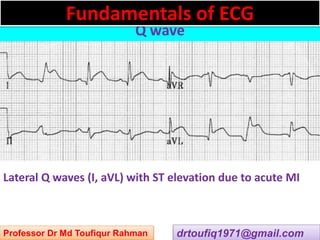 Approach to a patient with Q wave abnormality in ECG | PPSX