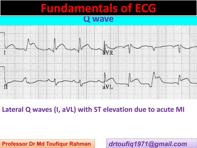 Approach to a patient with Q wave abnormality in ECG | PPT