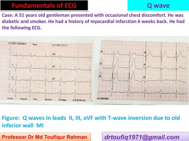 Approach to a patient with Q wave abnormality in ECG | PPT