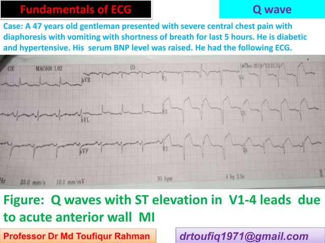 Approach to a patient with Q wave abnormality in ECG | PPT