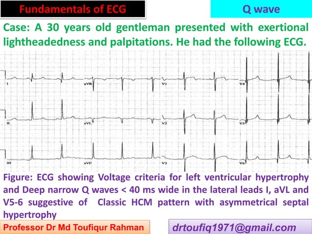 Approach to a patient with Q wave abnormality in ECG | PPT