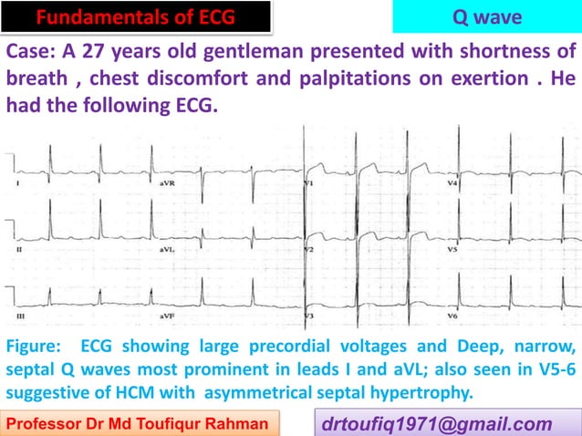 Approach to a patient with Q wave abnormality in ECG | PPT