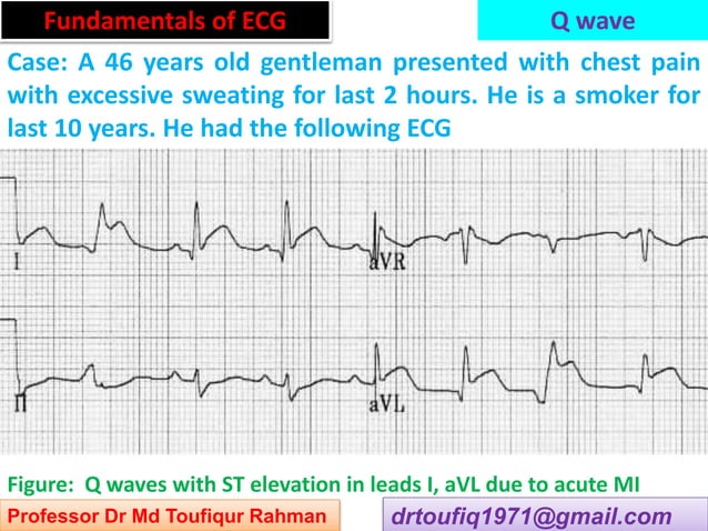Approach to a patient with Q wave abnormality in ECG | PPT