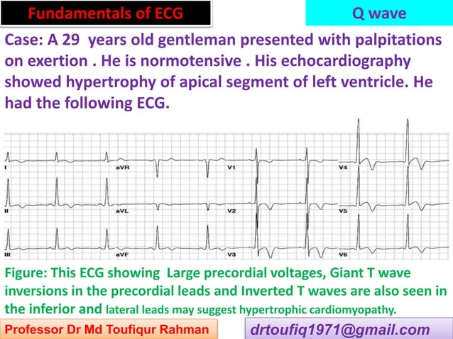 Approach to a patient with Q wave abnormality in ECG | PPT