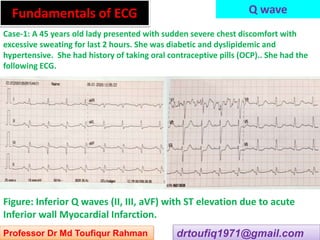 Abnormal Q Wave Mi