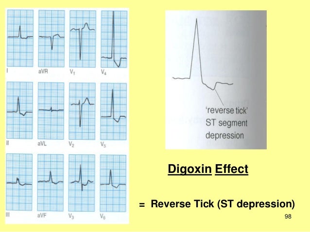 ECG in GP By Prof.Dr.R.R.Deshpande