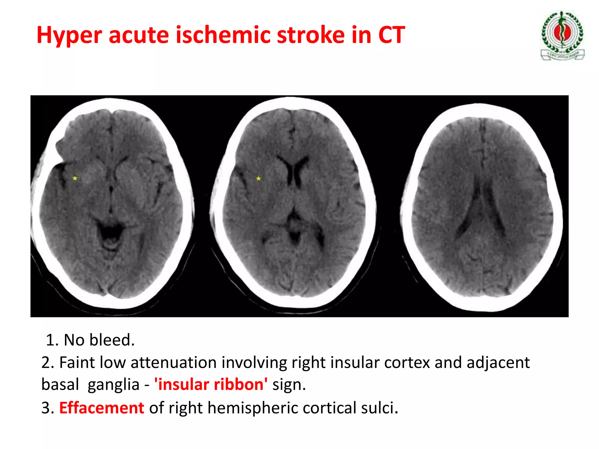 Recent Management of Acute ischaemic Stroke – An Update | PPTX