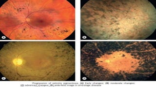 Retinitis Pigmentosa - Long Case Presentation by Dr. Muhammad Zeeshan ...