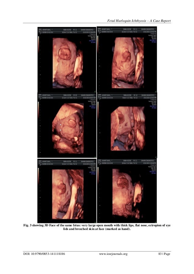Harlequin Ichthyosis Ultrasound Harlequin Ichthyosis Is A Rare, Severe