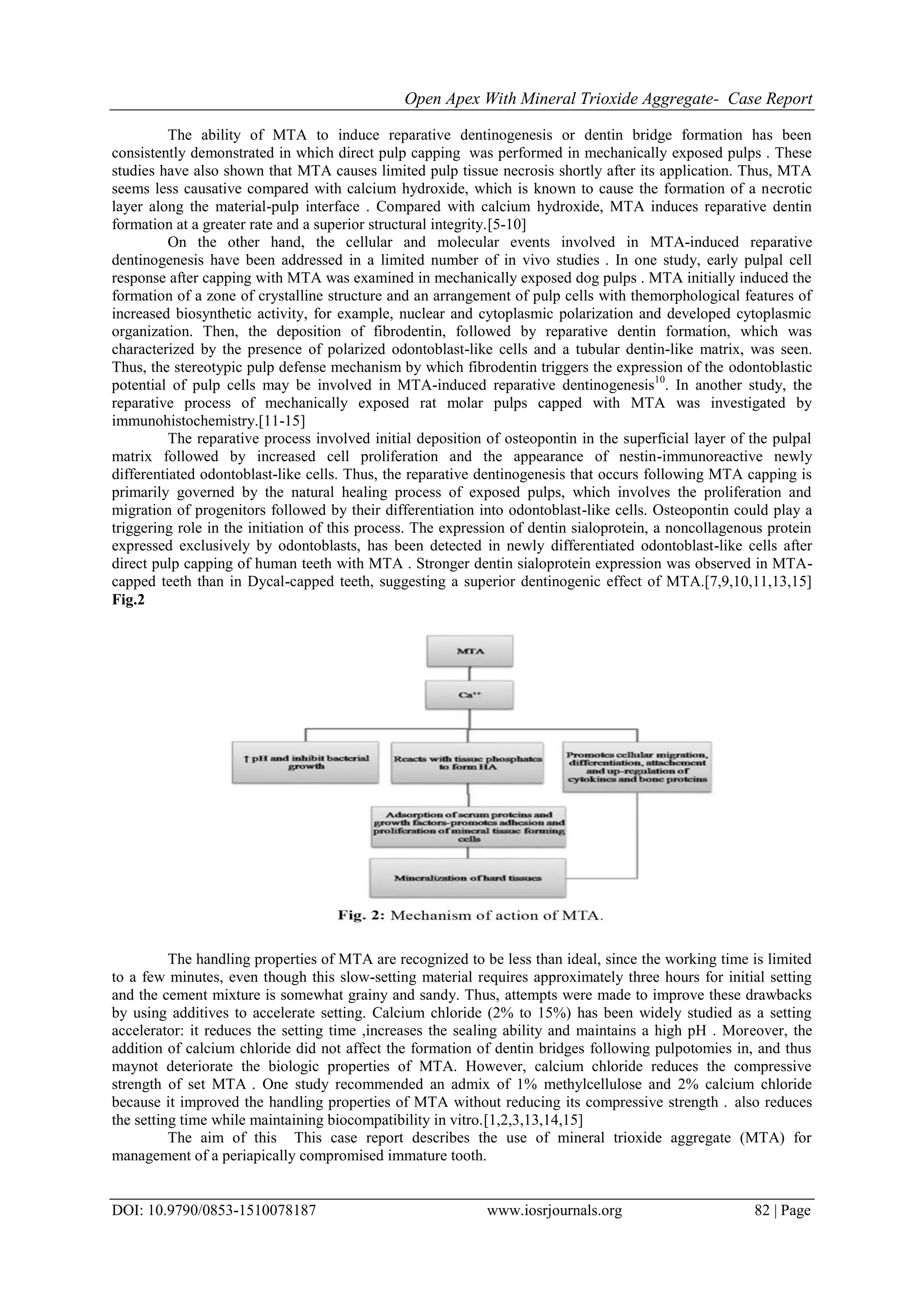 Open Apex with Mineral Trioxide Aggregate- Case Report | PDF