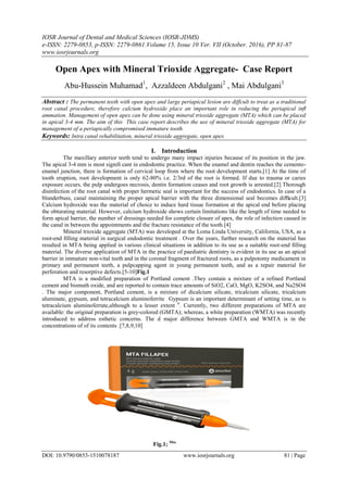 Open Apex with Mineral Trioxide Aggregate- Case Report | PDF