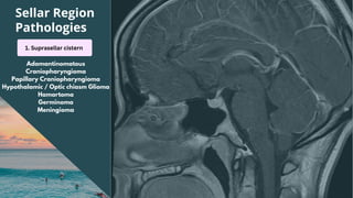R23_282_Sellar_Region_Pathology_compressed.pdf