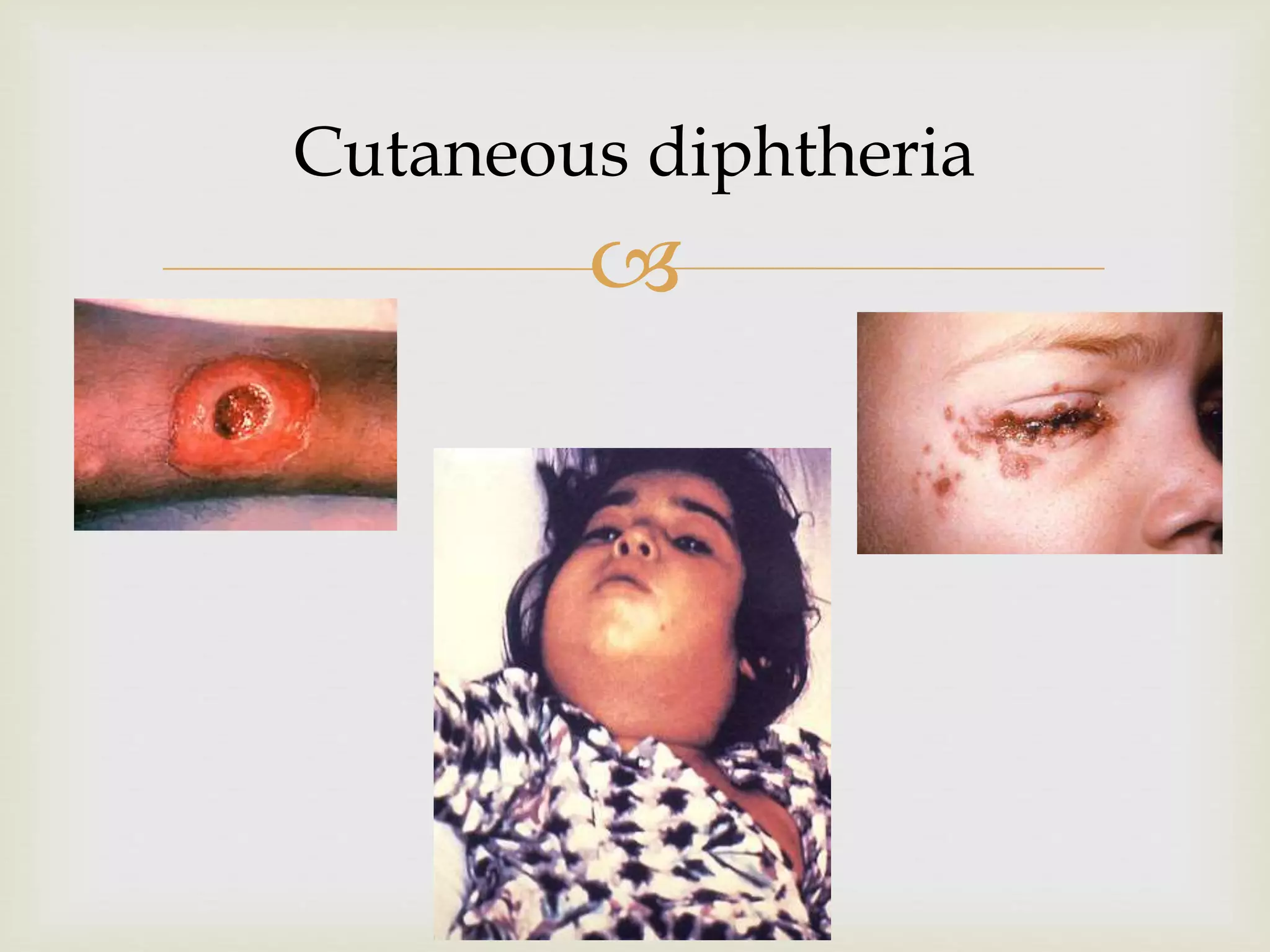 Corynebacterium diphtheriae | PPT