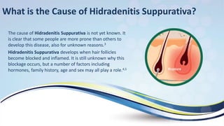 Hidradenitis | PPTX