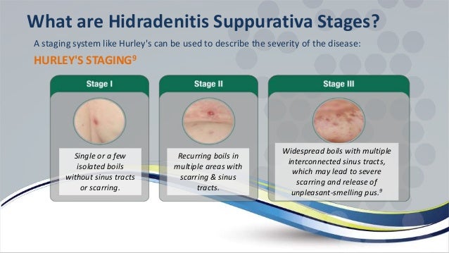 Hidradenitis Suppurativa Stage 3