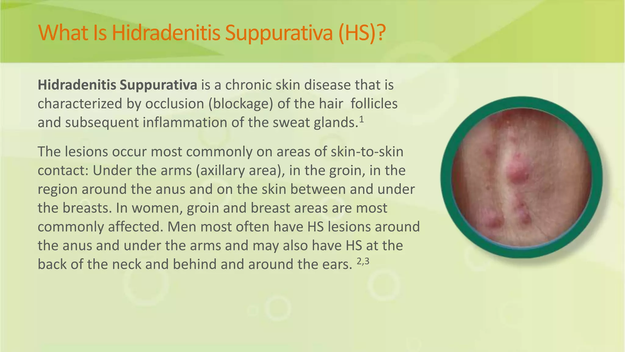 Hidradenitis Suppurativa | PPTX