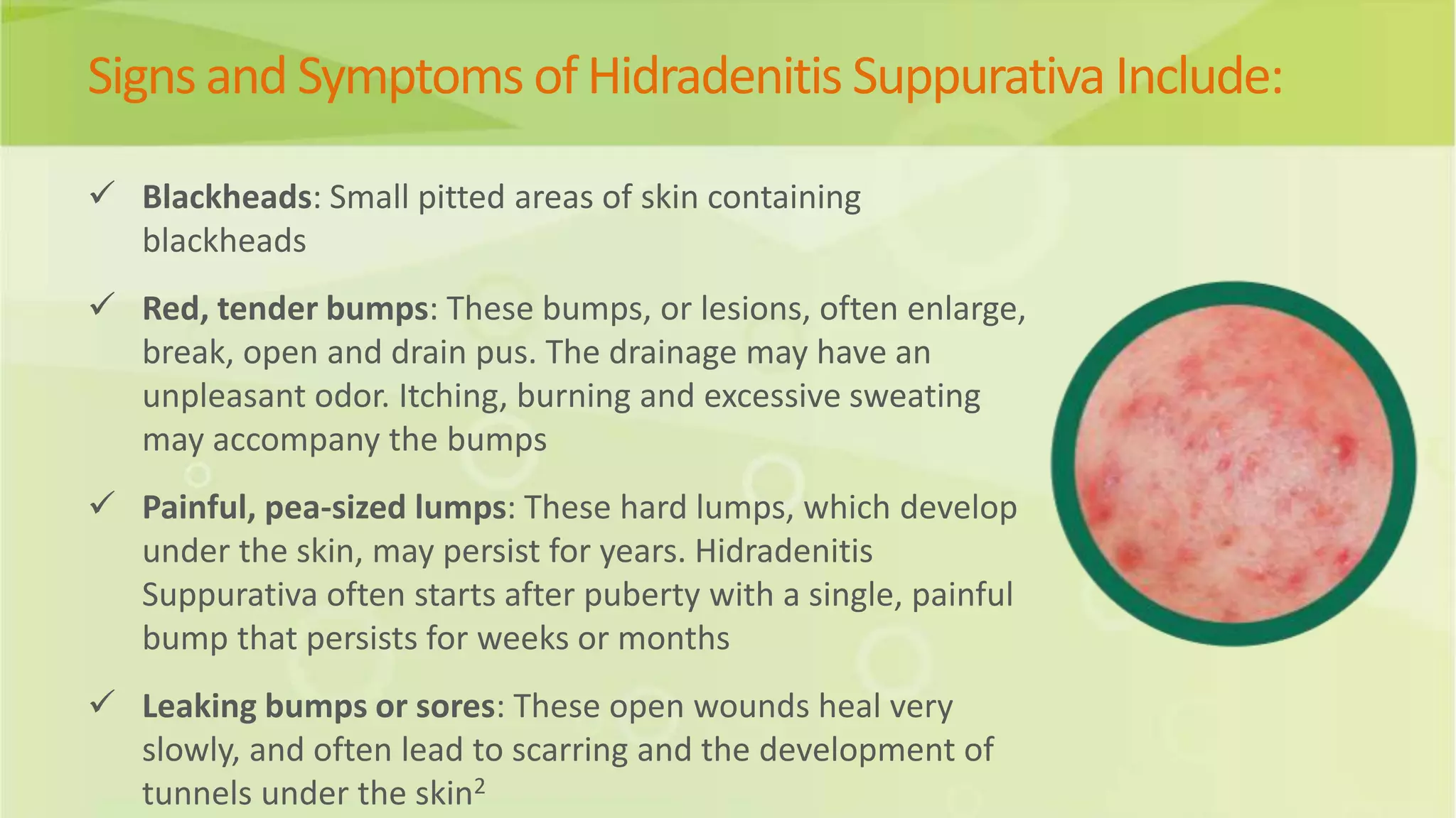 Hidradenitis Suppurativa | PPTX