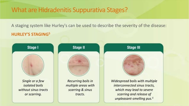 Hidradenitis Suppurativa | PPTX