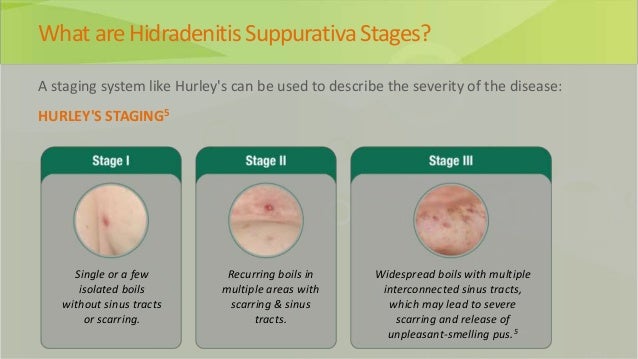 Hidradenitis Suppurativa