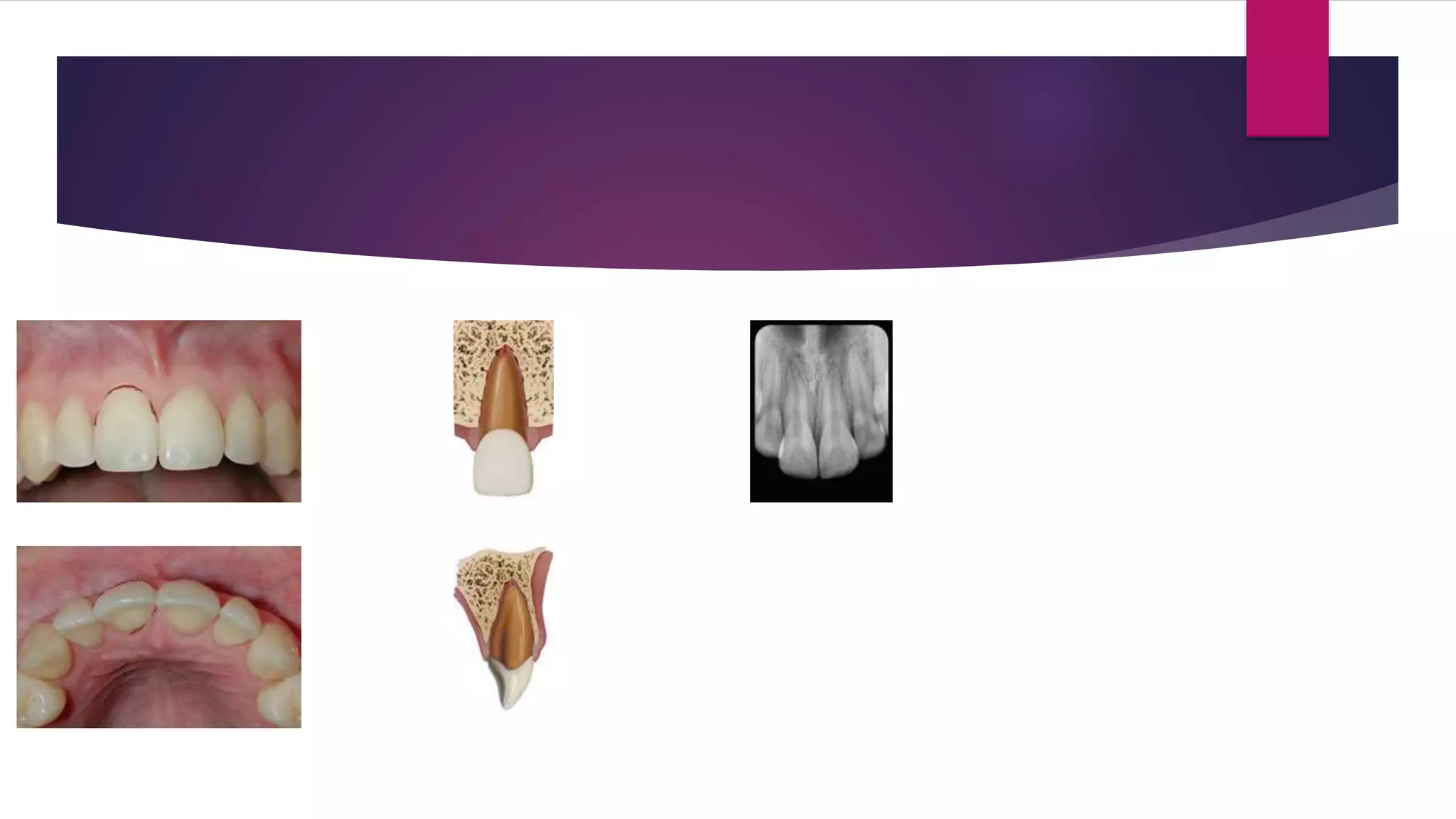 Luxation tooth injuries | PPTX