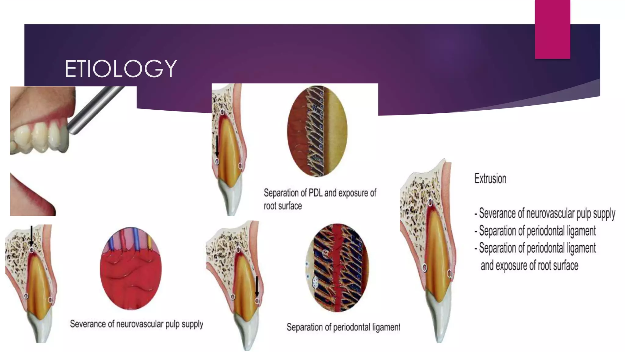Luxation tooth injuries | PPTX