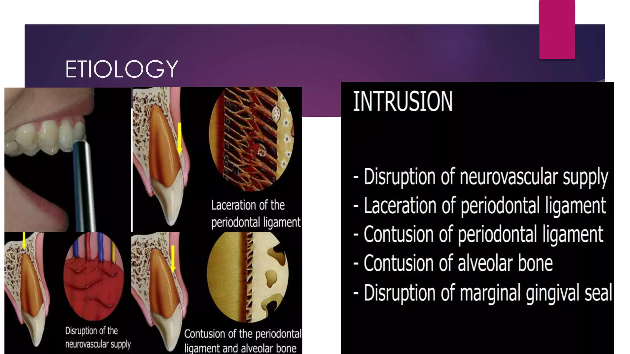 Luxation tooth injuries | PPTX
