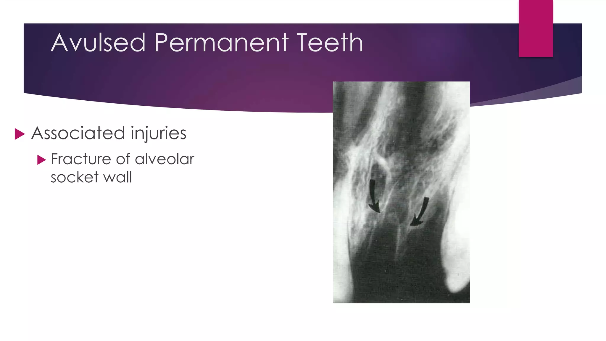 Luxation tooth injuries | PPTX