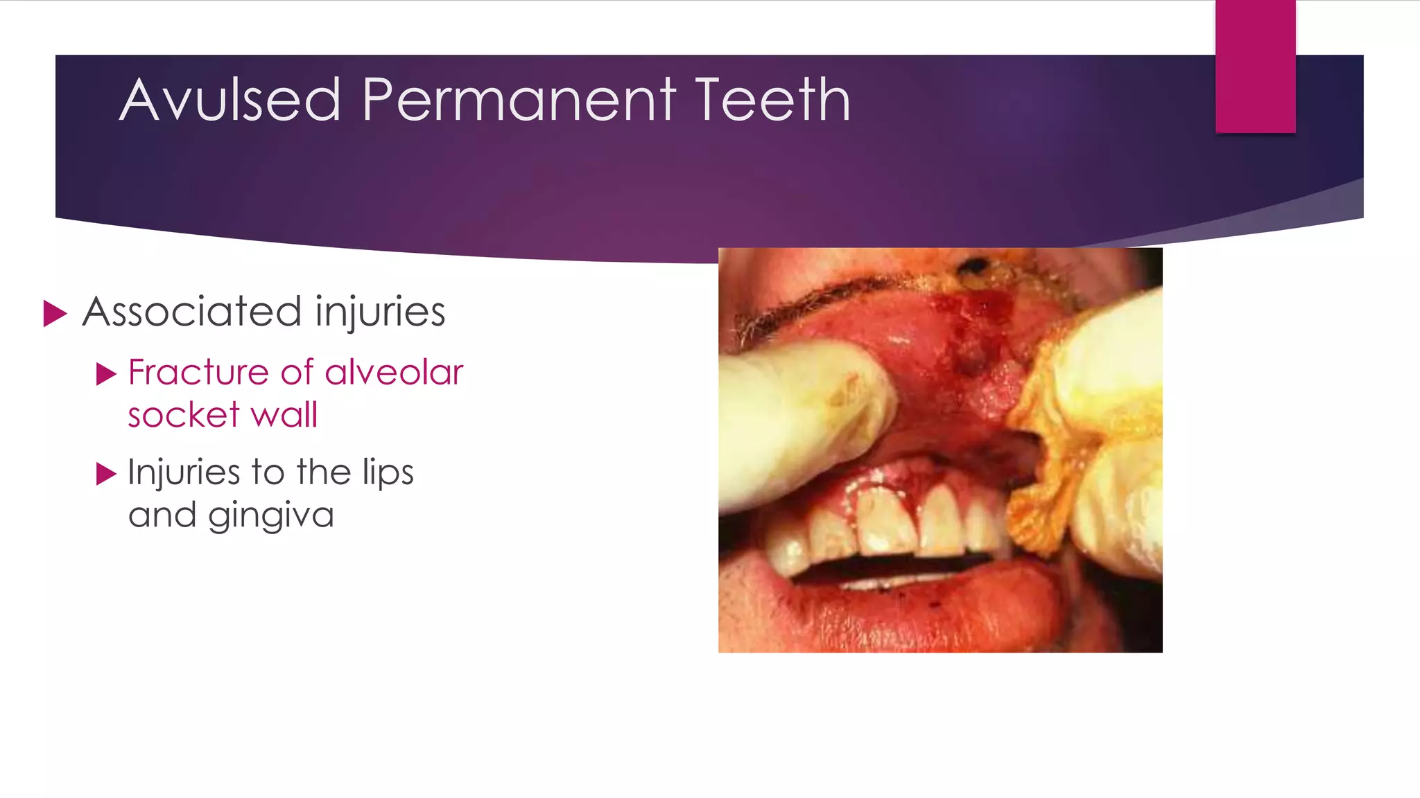 Luxation tooth injuries | PPTX