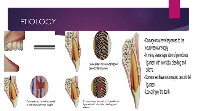 Luxation tooth injuries | PPTX
