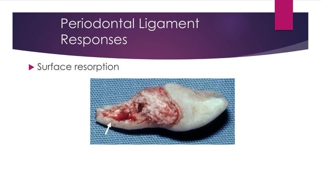 Luxation tooth injuries | PPTX