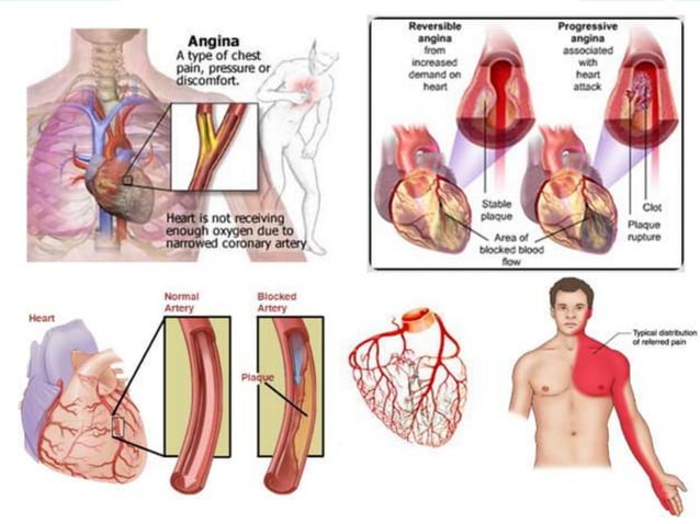 CVS-_Angina_Pectoris.pdf