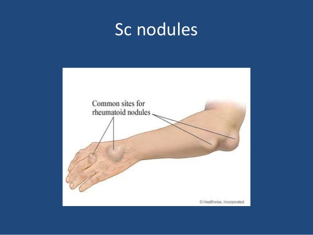 Heberdens Nodes Predict Knee Oa Progression Rheumnow