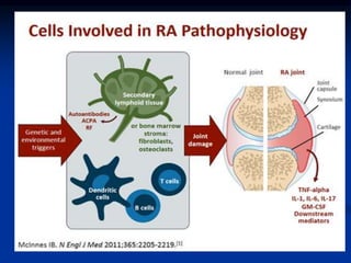 Rheumatois arthritis , pain management.. | PPTX