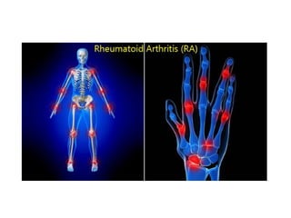 Rheumatoid Arthritis (RA) - Definition, Causes, Symptoms, Treatment and ...