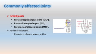 Rhumatoid Arthritis | PPT