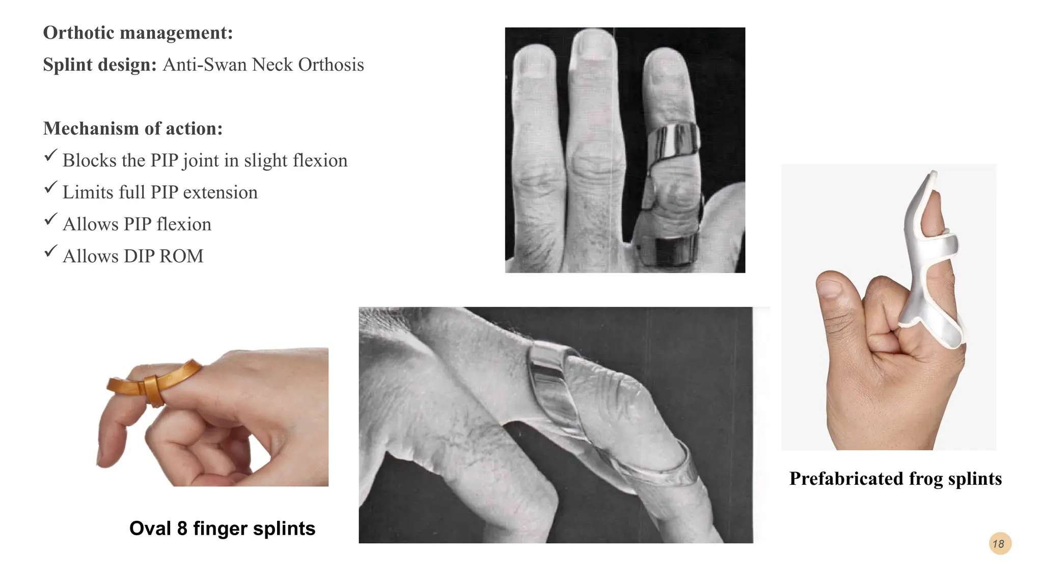 Upper Extremity Splinting for Rheumatoid Arthritis | PPTX