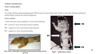 Upper Extremity Splinting for Rheumatoid Arthritis | PPTX