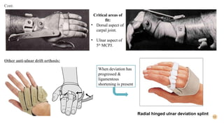 Upper Extremity Splinting for Rheumatoid Arthritis | PPTX