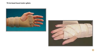 Upper Extremity Splinting for Rheumatoid Arthritis | PPTX