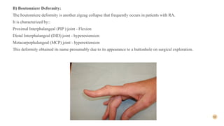 Upper Extremity Splinting for Rheumatoid Arthritis | PPTX