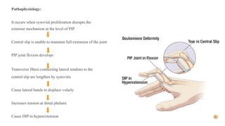 Upper Extremity Splinting for Rheumatoid Arthritis | PPTX