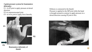 Upper Extremity Splinting for Rheumatoid Arthritis | PPTX