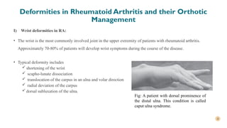 Upper Extremity Splinting for Rheumatoid Arthritis | PPTX