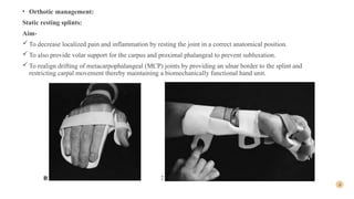 Upper Extremity Splinting for Rheumatoid Arthritis | PPTX