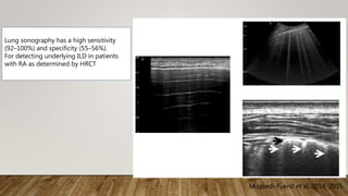 RA-ILD | PPTX