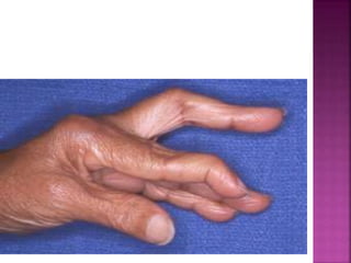 RA-rhemautoid athritis.pptx